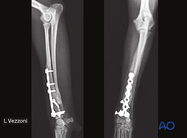 Lag screw and cranial plate fixation for Simple complete articular ...