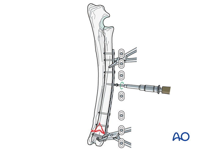 Lag screw and bridging plate fixation for Simple articular ...