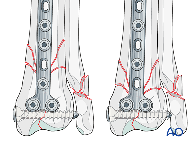 Lag screw and bridging plate fixation for Simple articular ...