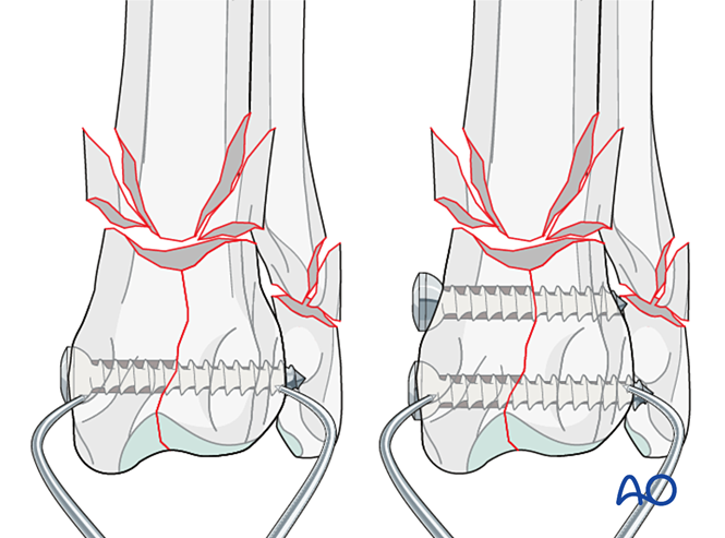 Lag screw and medial bridging plate fixation for Simple articular ...