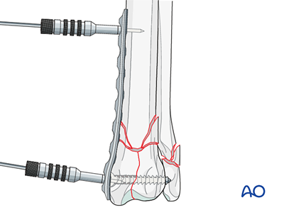 Lag screw and medial bridging plate fixation for Simple articular ...