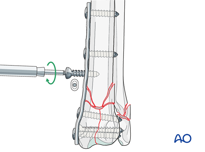Lag screw and medial bridging plate fixation for Simple articular ...