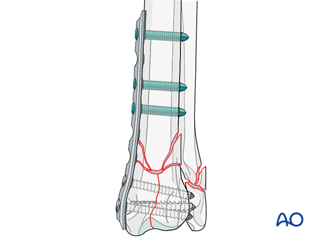 Lag screw and medial bridging plate fixation for Simple articular ...