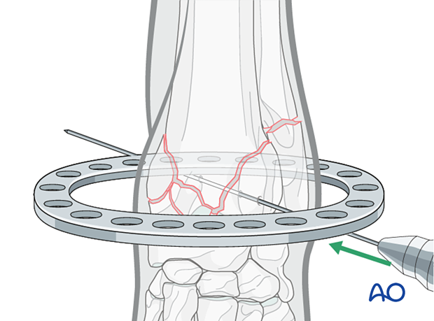 Pancarpal arthrodesis with a circular or hybrid external skeletal ...