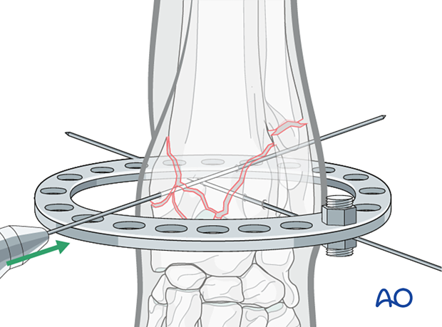 Pancarpal arthrodesis with a circular or hybrid external skeletal ...