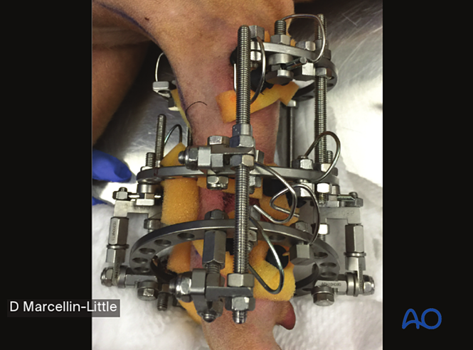 Pancarpal arthrodesis with a circular or hybrid external skeletal ...
