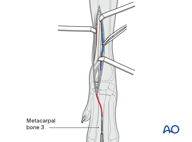Pancarpal arthrodesis with a plate for Multifragmentary complete ...