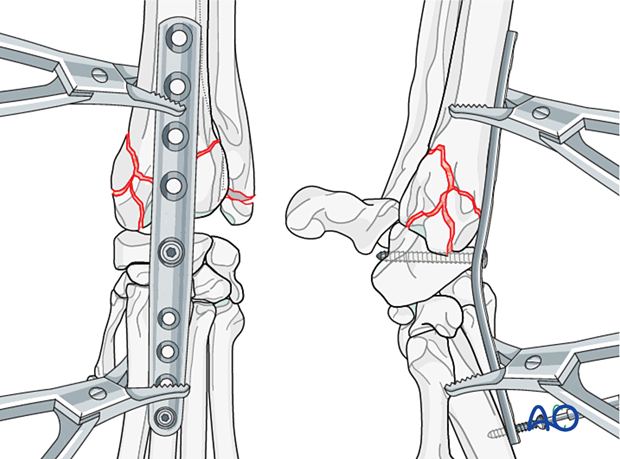 Pancarpal arthrodesis with a plate for Multifragmentary complete ...