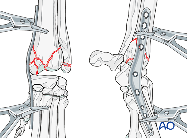 Pancarpal arthrodesis with a plate for Multifragmentary complete ...