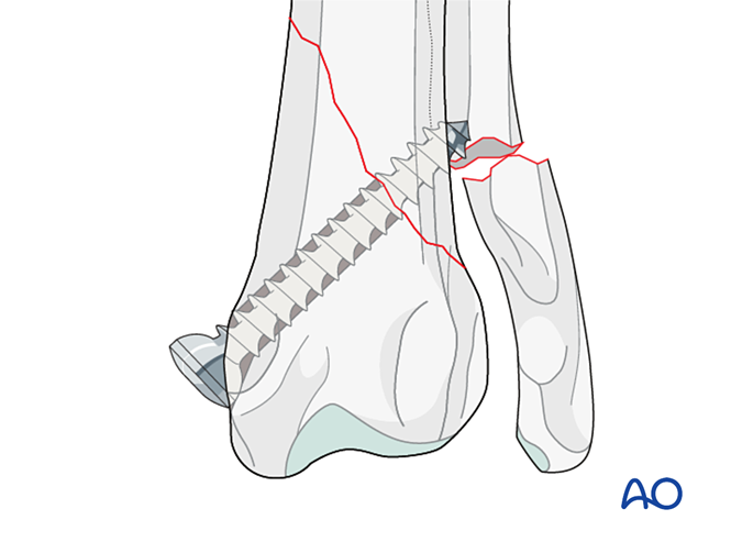 Lag screw fixation