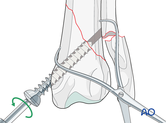 Lag screw fixation