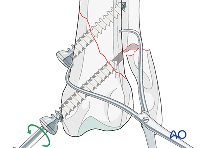 Lag screw fixation