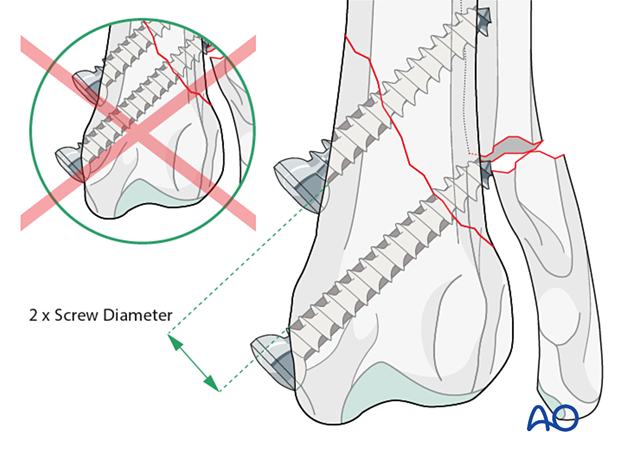 Lag screw fixation