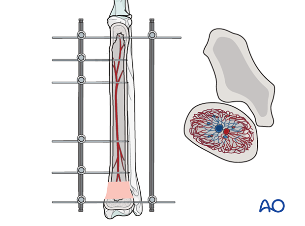 General considerations on external skeletal fixators