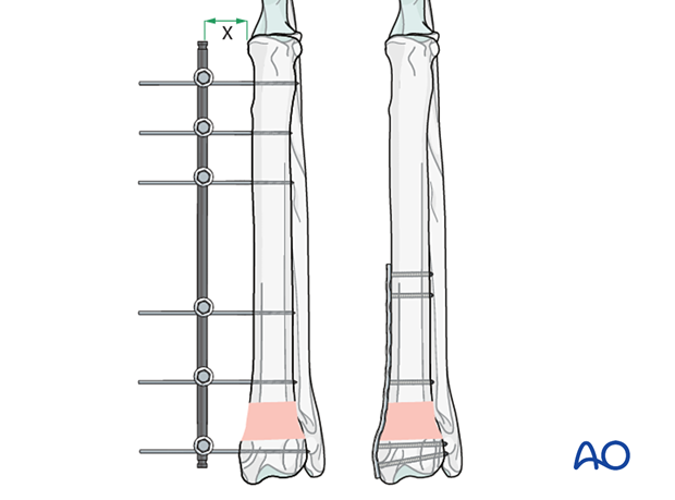 General considerations on external skeletal fixators