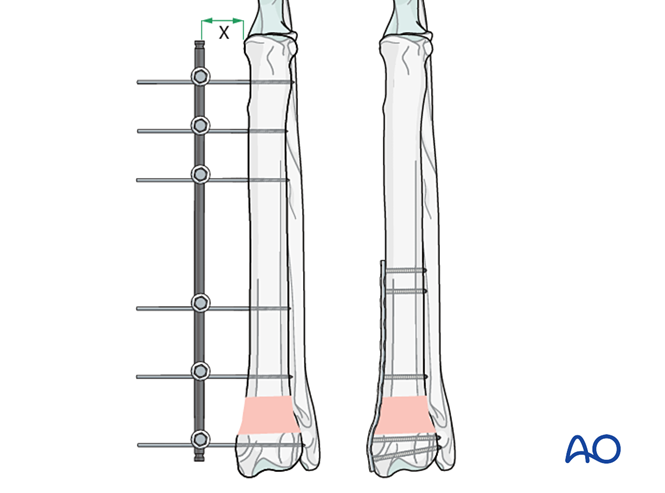 General considerations on external skeletal fixators