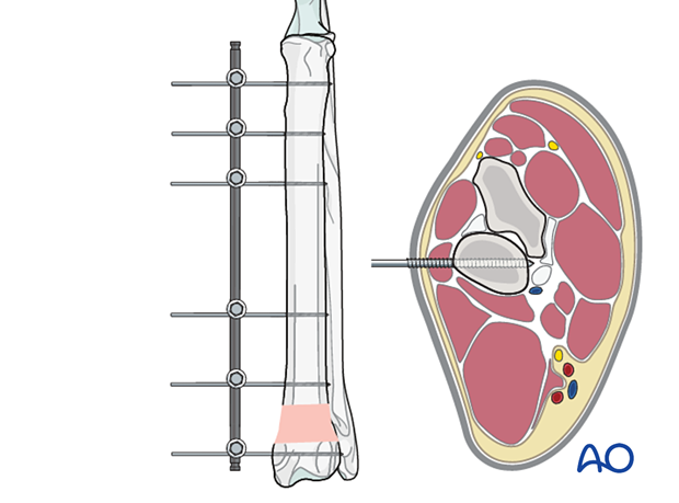 General considerations on external skeletal fixators
