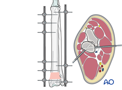 General considerations on external skeletal fixators