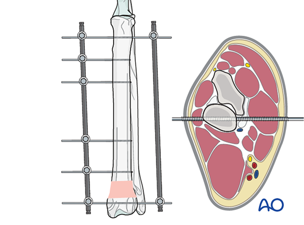 General considerations on external skeletal fixators