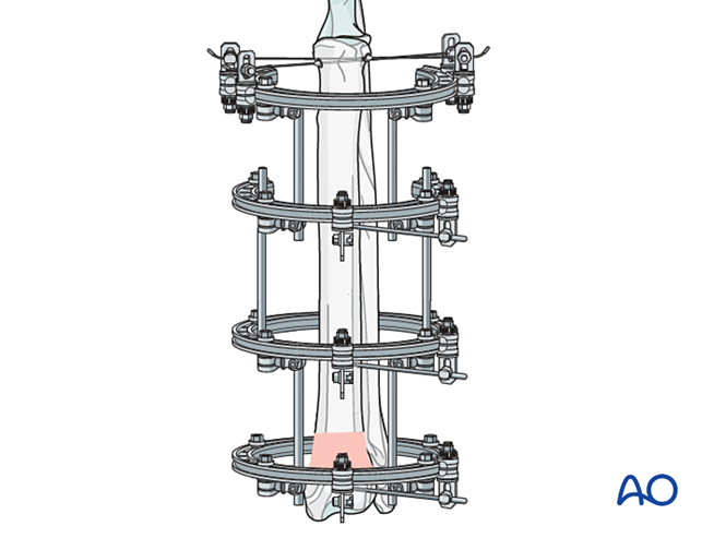 General considerations on external skeletal fixators