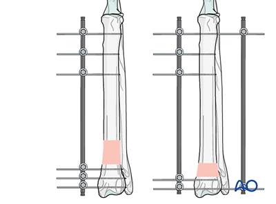 General considerations on external skeletal fixators