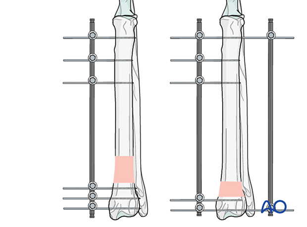 General considerations on external skeletal fixators