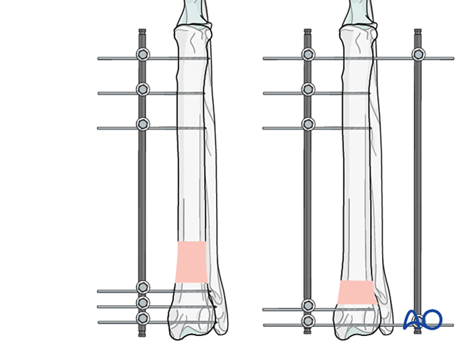 General considerations on external skeletal fixators