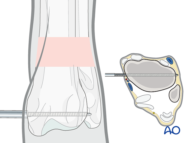 General considerations on external skeletal fixators