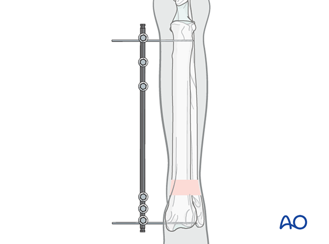 General considerations on external skeletal fixators