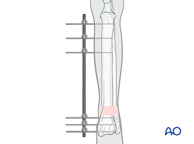 General considerations on external skeletal fixators