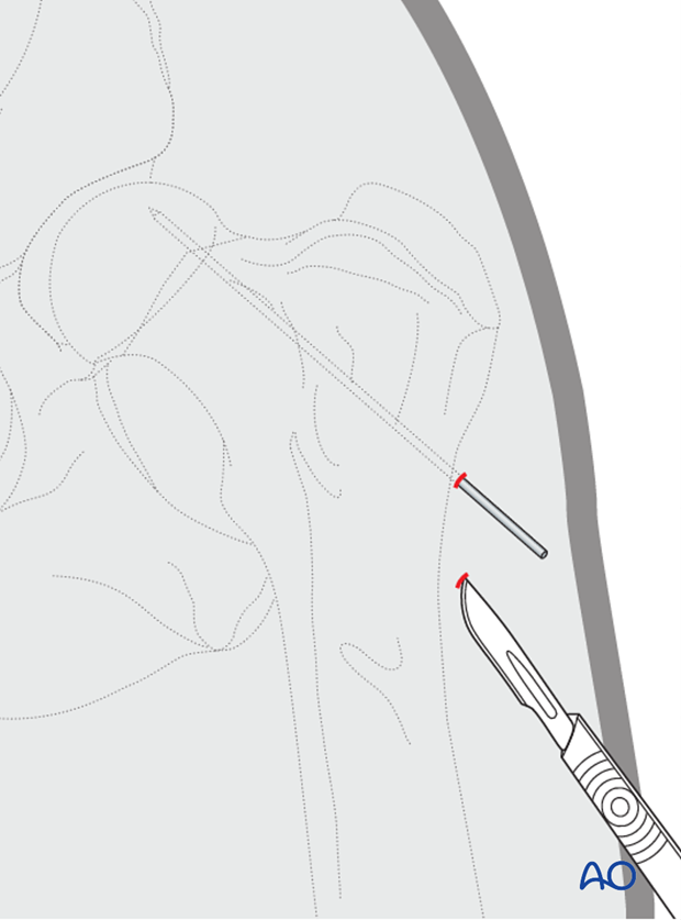 Parallel K-wires for Simple transcervical