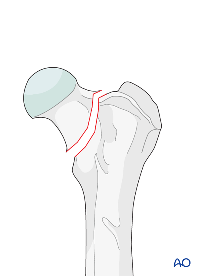 Simple basicervical fracture