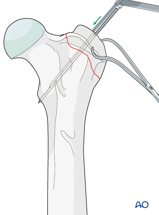 Tension band for Trochanteric region, avulsion