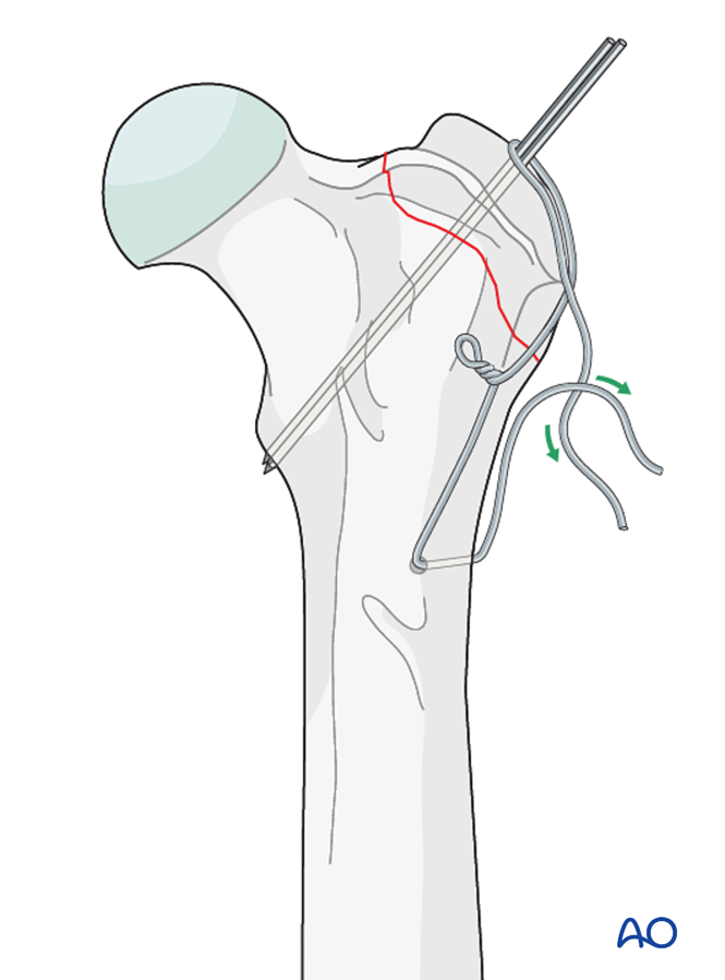 Tension band for Trochanteric region, avulsion