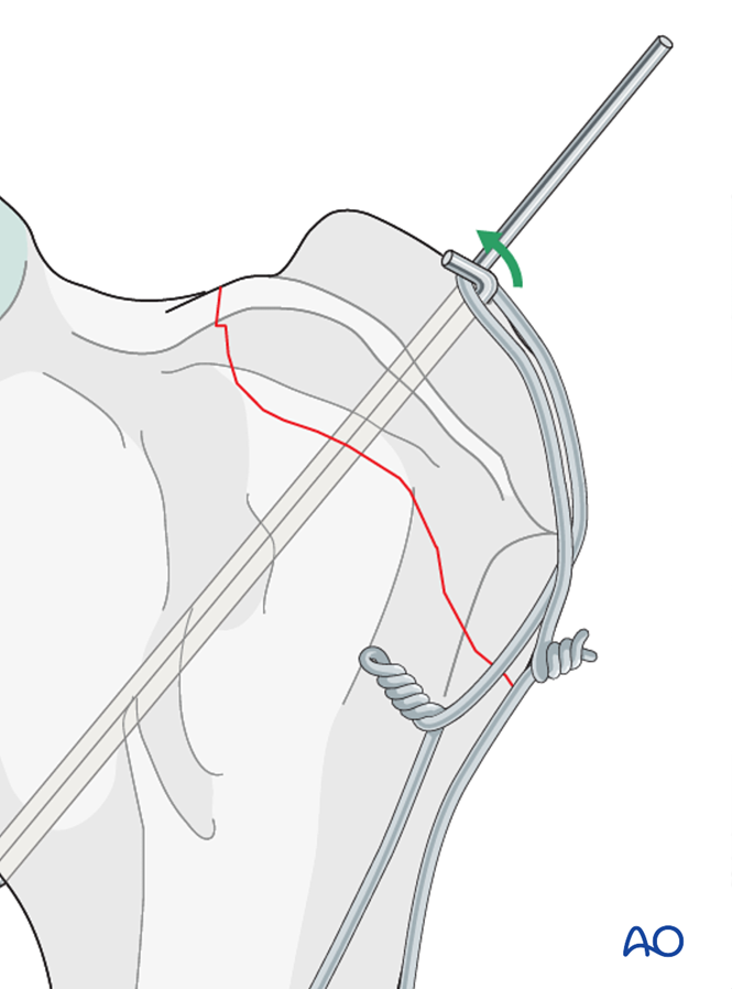 Tension band for Trochanteric region, avulsion