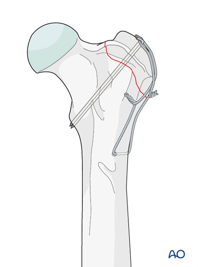 Tension band for Trochanteric region, avulsion