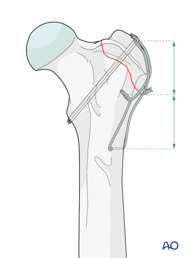 Tension band for Trochanteric region, avulsion