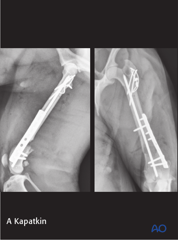 Tension band for Trochanteric region, avulsion