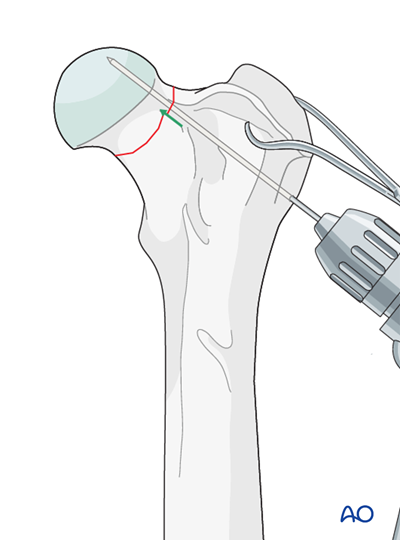 Lag screw and K-wire for Simple transcervical