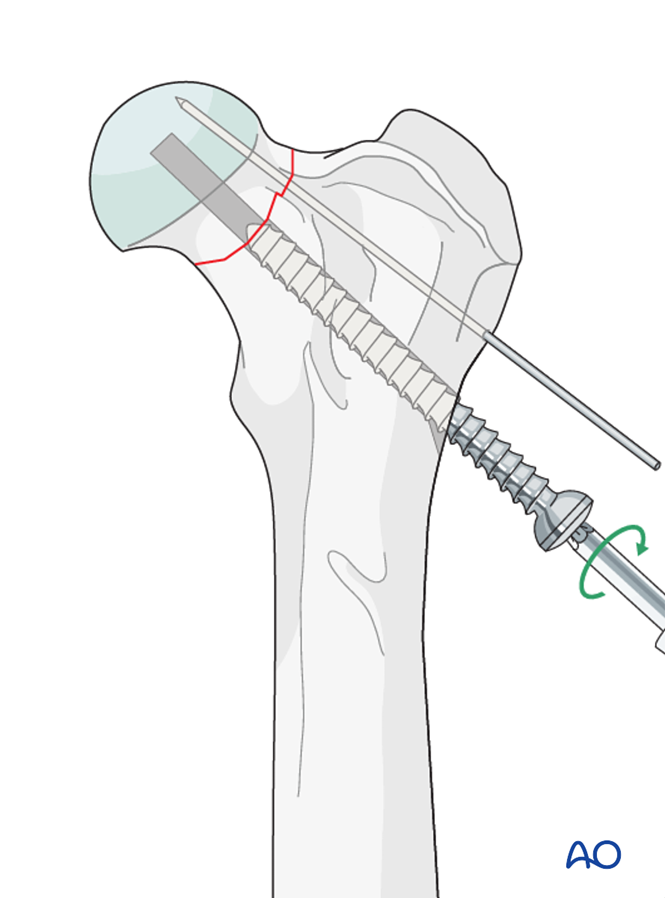 Lag screw and K-wire for Simple transcervical