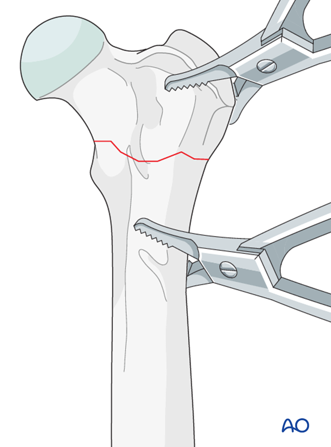 Plate fixation for Trochanteric region, intertrochanteric simple