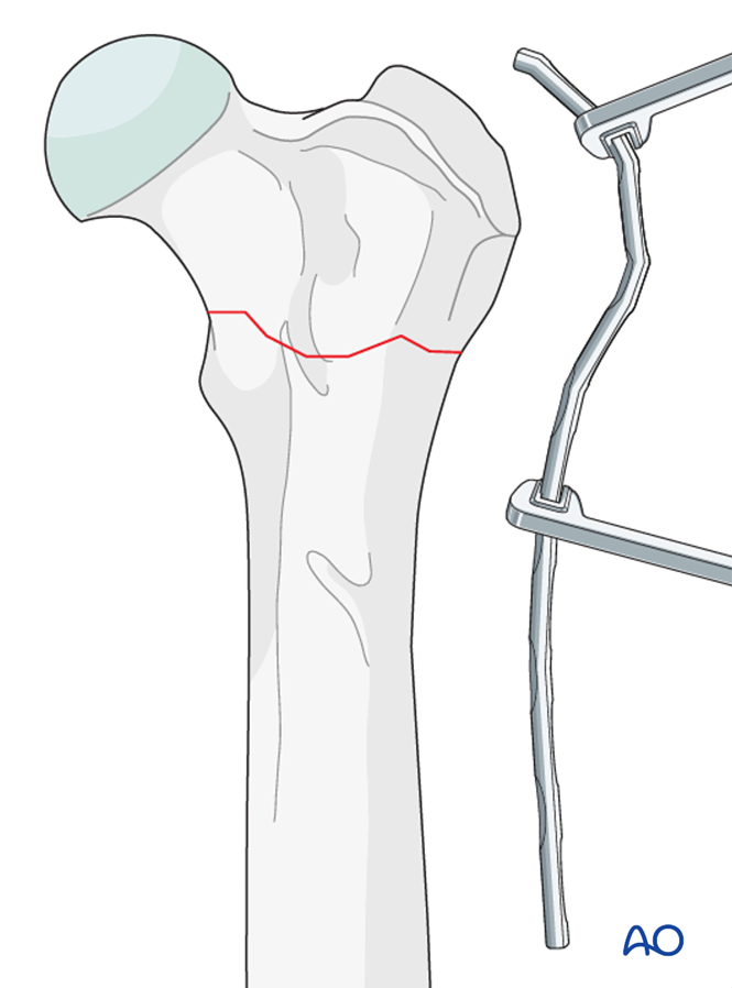 Plate fixation for Trochanteric region, intertrochanteric simple