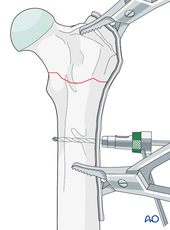 Plate fixation for Trochanteric region, intertrochanteric simple