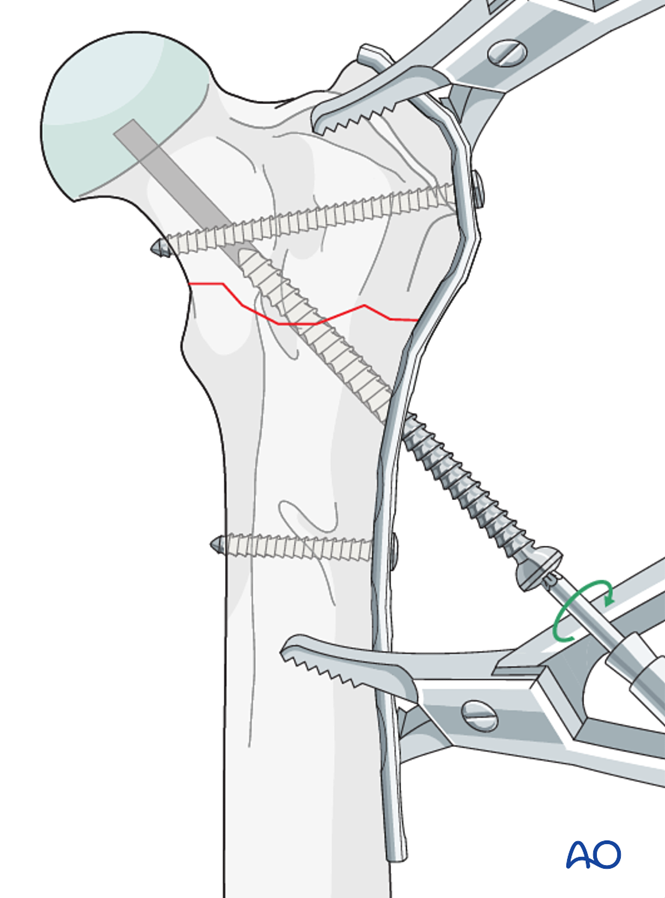 Plate fixation for Trochanteric region, intertrochanteric simple