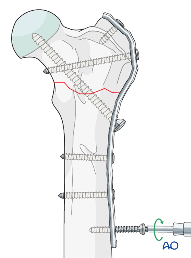 Plate fixation for Trochanteric region, intertrochanteric simple