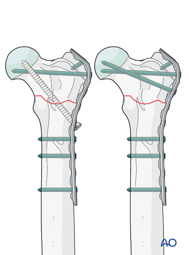 Plate fixation for Trochanteric region, intertrochanteric simple