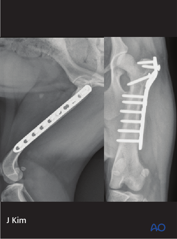 Plate fixation for Trochanteric region, intertrochanteric simple