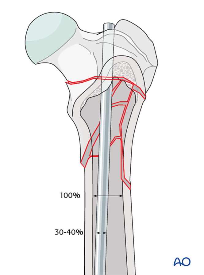 Plate and rod for Trochanteric region, multifragmentary