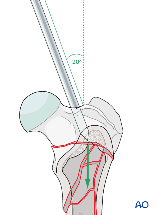 Plate and rod for Trochanteric region, multifragmentary