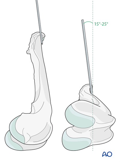 Plate and rod for Trochanteric region, multifragmentary